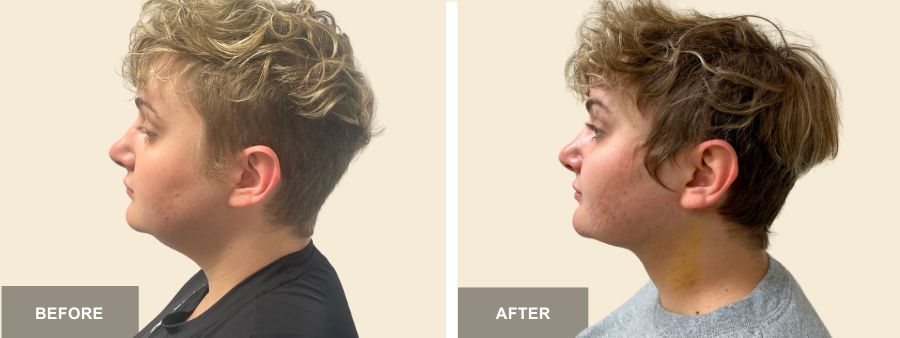 Neck Submental Liposuction | South Florida Center for Cosmetic Surgery