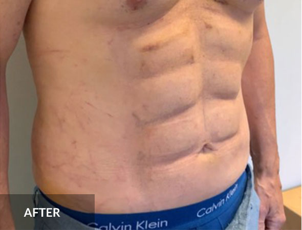 Abdominal Etching | South Florida Center for Cosmetic Surgery