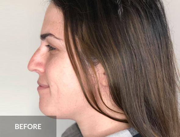 Rhinoplasty Nose Reshaping | South Florida Center for Cosmetic Surgery