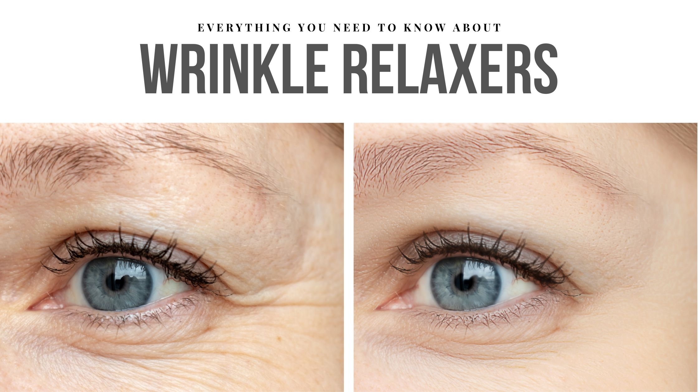 Wrinkle Relaxers to Get Rid of Wrinkles | South Florida Center for ...